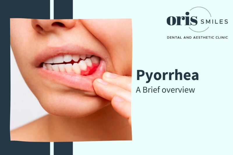 What is pyorrhoea - Oris Smiles
